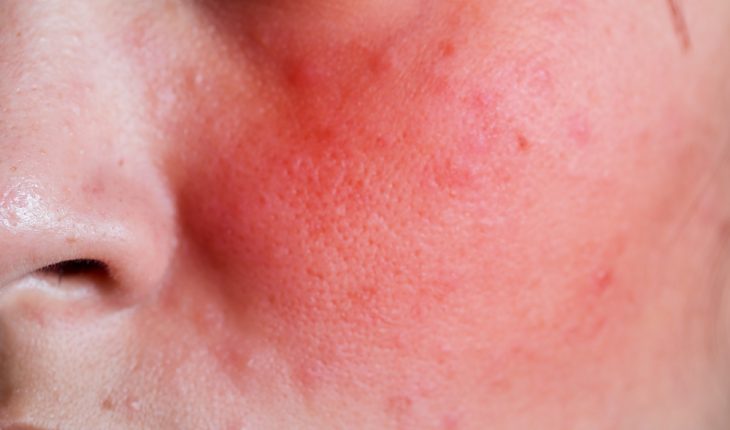 Why Is My Skin Red?|thirdAGE